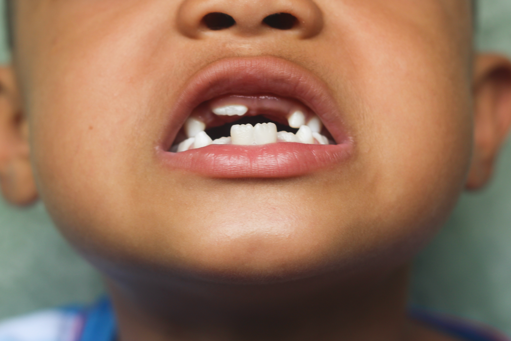 New Zealand Dental Association | NZDA concern over dental health of…