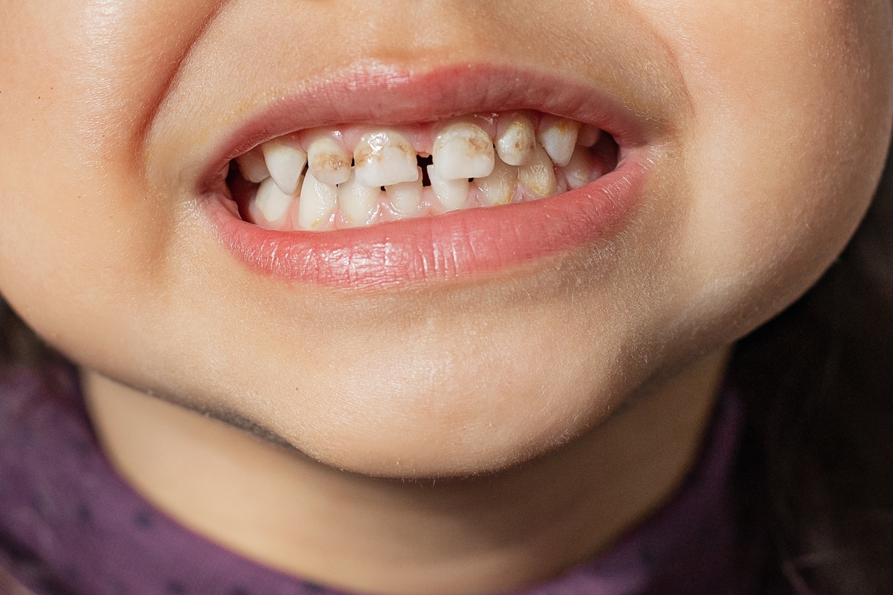 New Zealand Dental Association | NZDA comment on children waiting for…